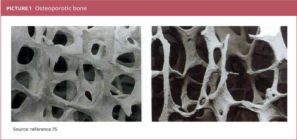 Probiotics and Osteoporosis -What Do We Know Today? - B2B Nutramedic ...